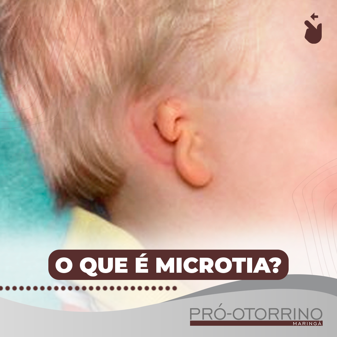O que é Microtia? 🤔 - Pró Otorrino
